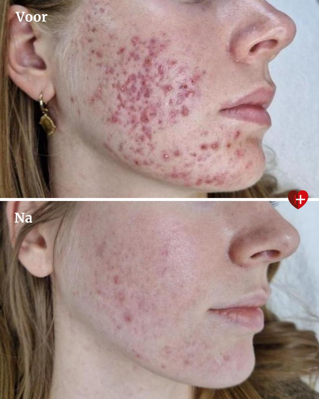 Littekens - Huidzorg Horst